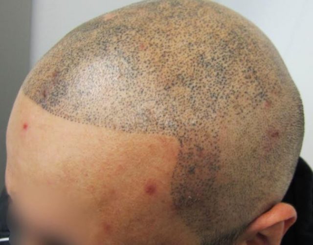 Slechte micro haartransplantatie voorkomen | Haarstichting